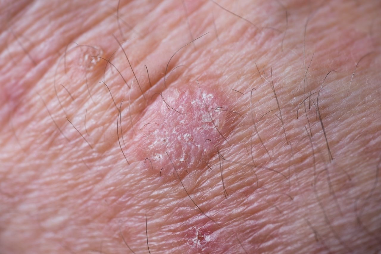 Actinic Keratosis - Contact Texas Dermatology Specialists | Top-Rated ...